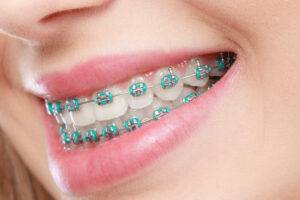 How Do Braces Actually Work